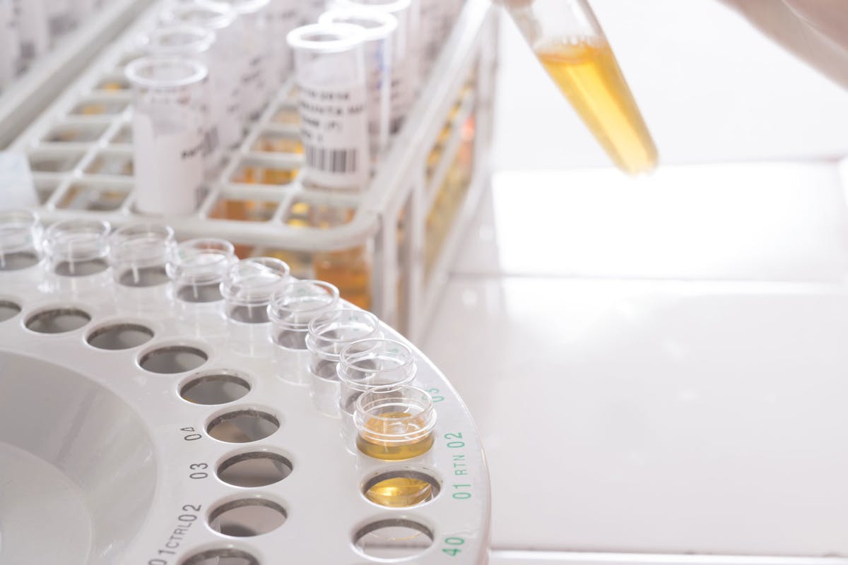 Urinalysis: Are we done spinning yet? | Medical Laboratory Observer