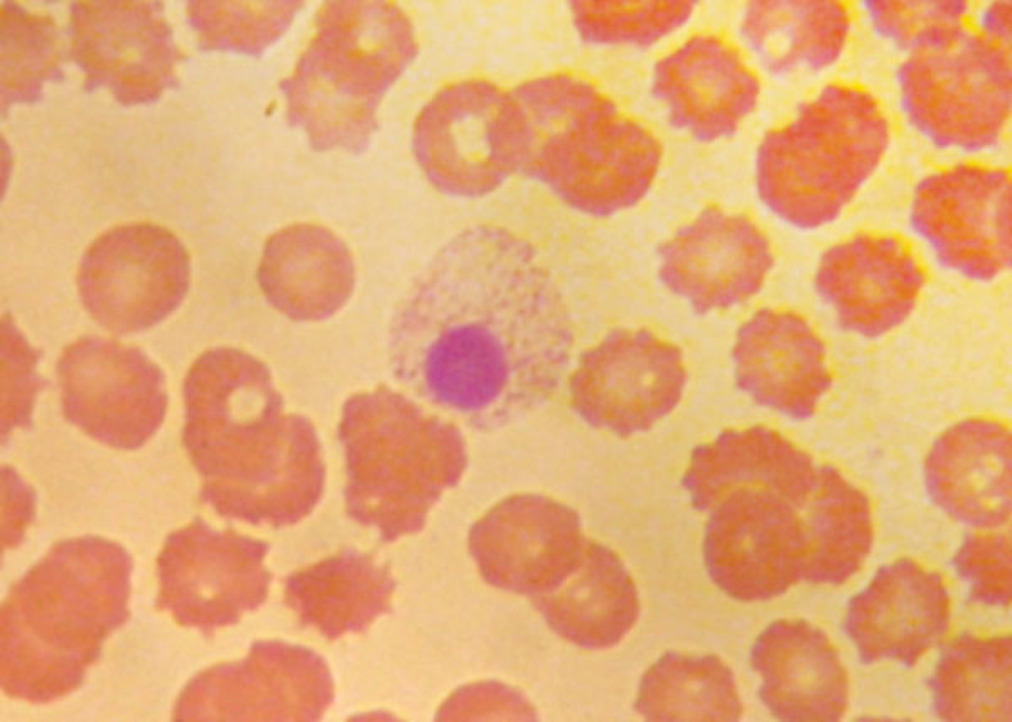 EDTA in transit: degenerative changes in blood cell morphology ...