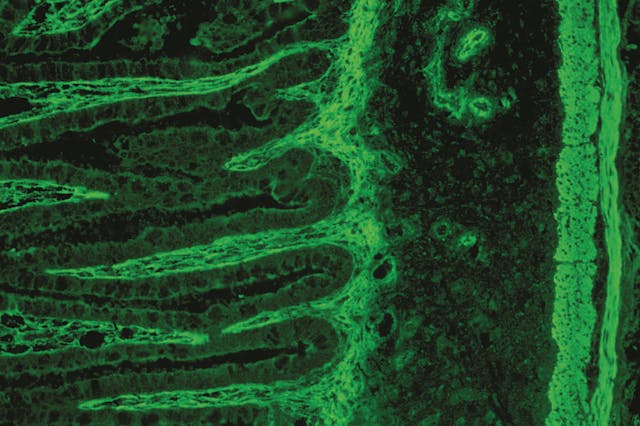 The prevalence, pathogenesis and diagnostics of celiac disease ...