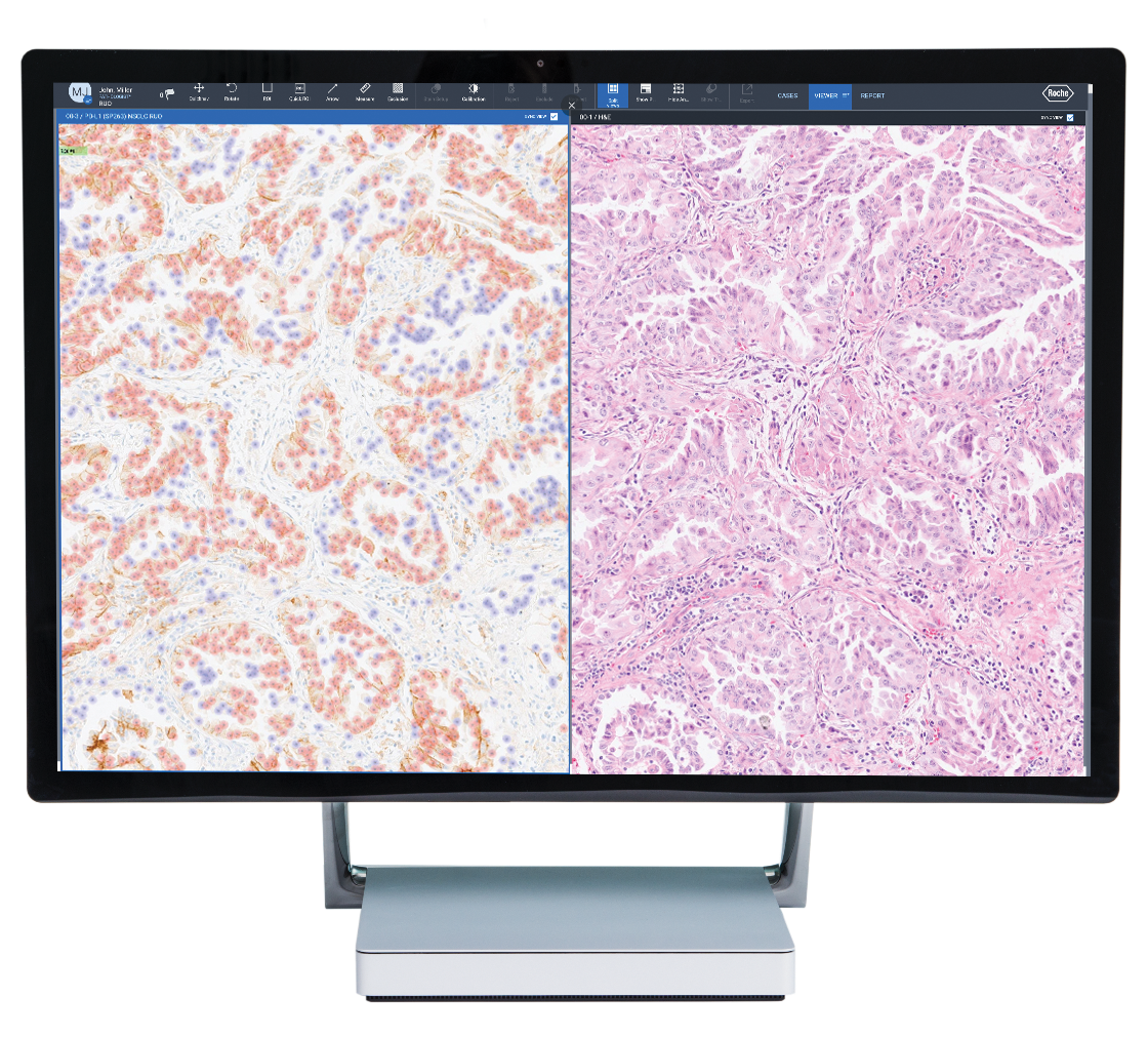 Roche launches digital pathology algorithm for non-small cell lung ...