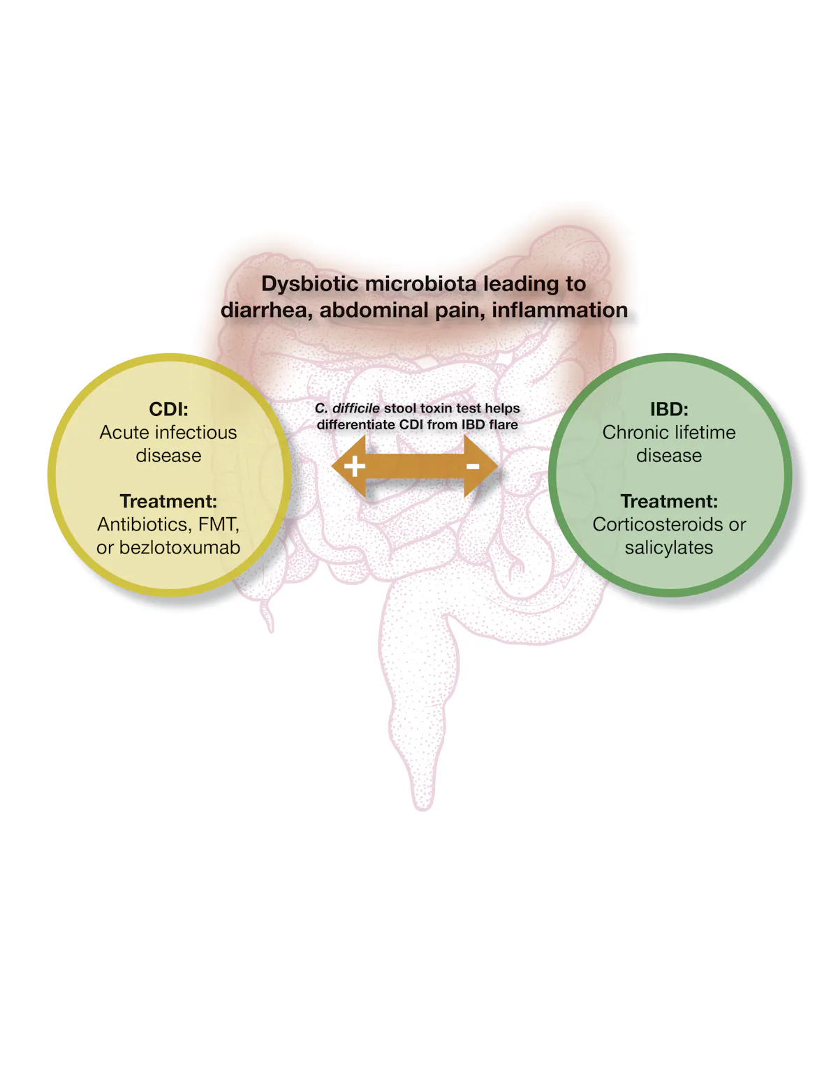 Clostridioides difficile in inflammatory bowel disease | Medical ...