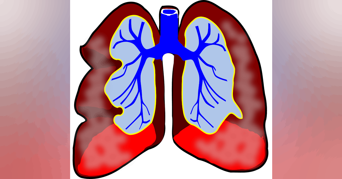 WHO Announces New TB Antigen based Skin Tests Medical Laboratory Observer who-announces-new-tb-antigen-based-skin-tests-medical-laboratory-observer