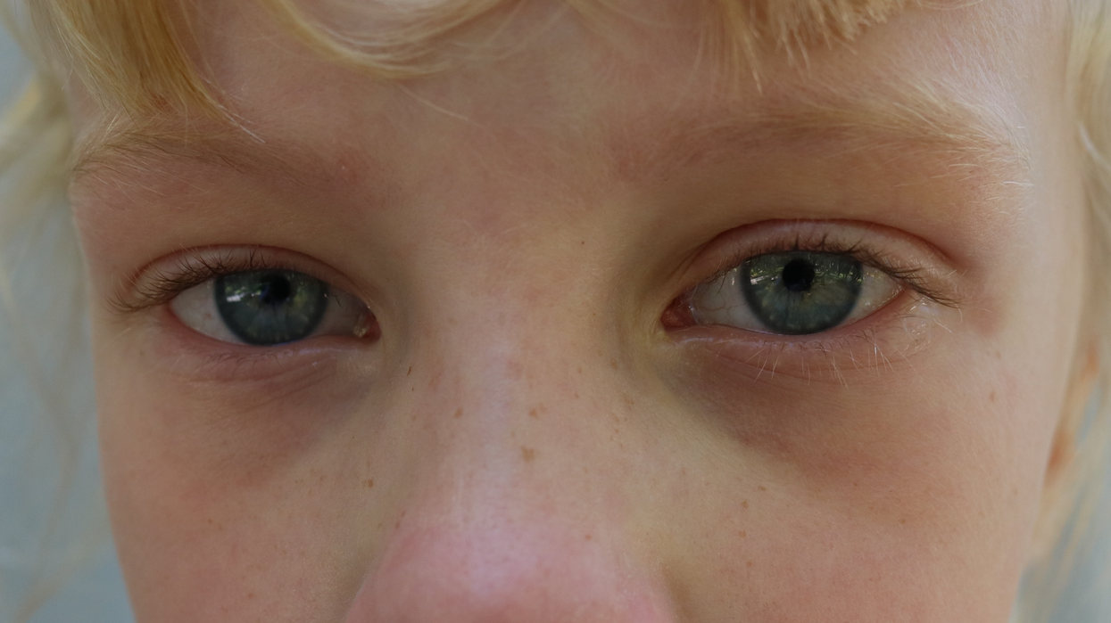 NIH researchers develop gene therapy for rare ciliopathy | Medical ...