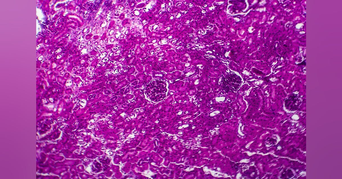 Study identifies biomarker for allergic reaction in kidneys | Medical ... Study identifies biomarker for allergic reaction in kidneys | Medical ...