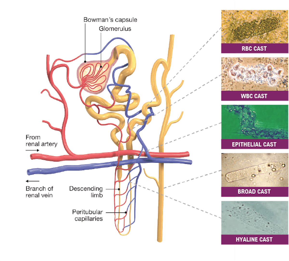 Urinary casts: Indicators of underlying clinical pathology | Medical ...