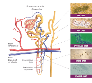 Urinary casts: Indicators of underlying clinical pathology | Medical ...