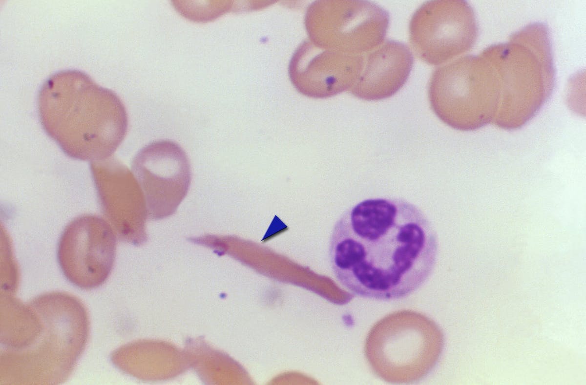 FDA approves first gene therapies to treat patients with sickle cell ...