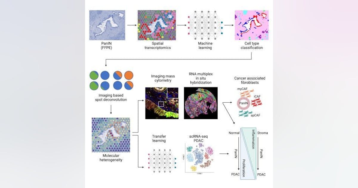 Johns Hopkins Researchers Identify Key Markers In Pancreatic Cancer Progression Using A New