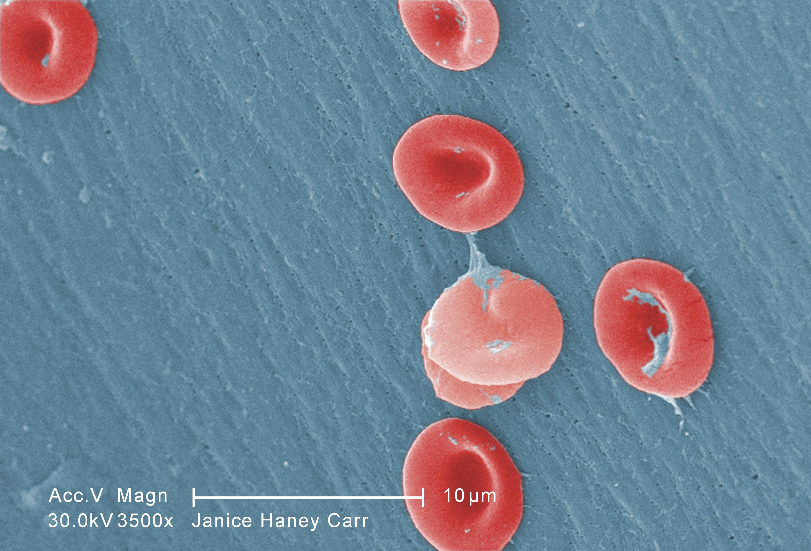 Genetic carriers for sickle cell disease have higher risks of blood ...